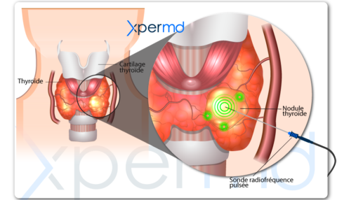 Radiofréquence ou alcoolisation de Nodules thyroïde